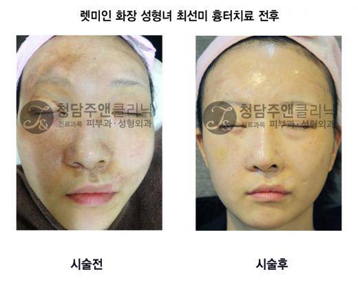 사고 후 수술 흉터 치료 레이저로 가능