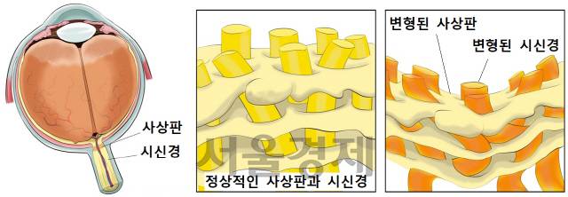 녹내장 치료 필요 불필요 판단기준 알아냈다