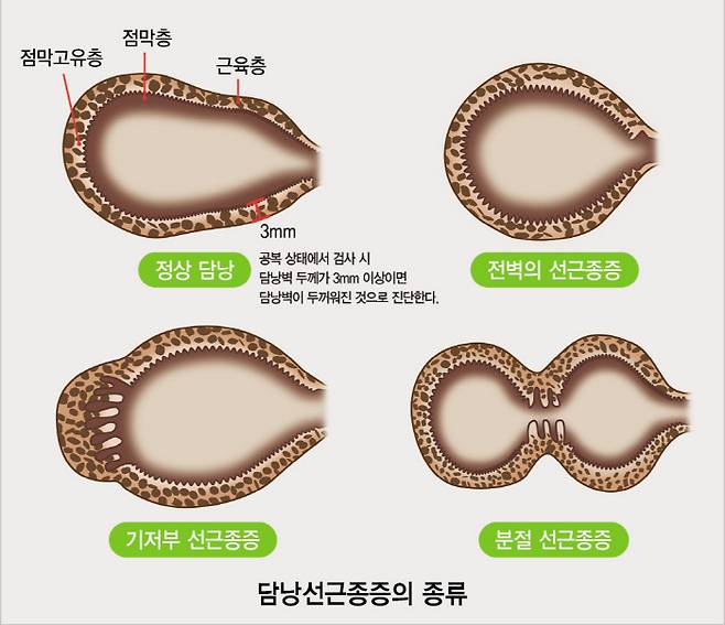 두꺼워져도 증상없는 담낭 놔두면 담낭암 진행