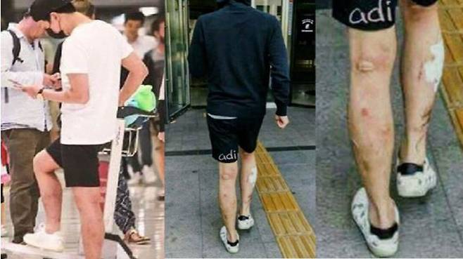 Pick 박유천 멍투성이 다리필로폰 부작용 메스버그 때문