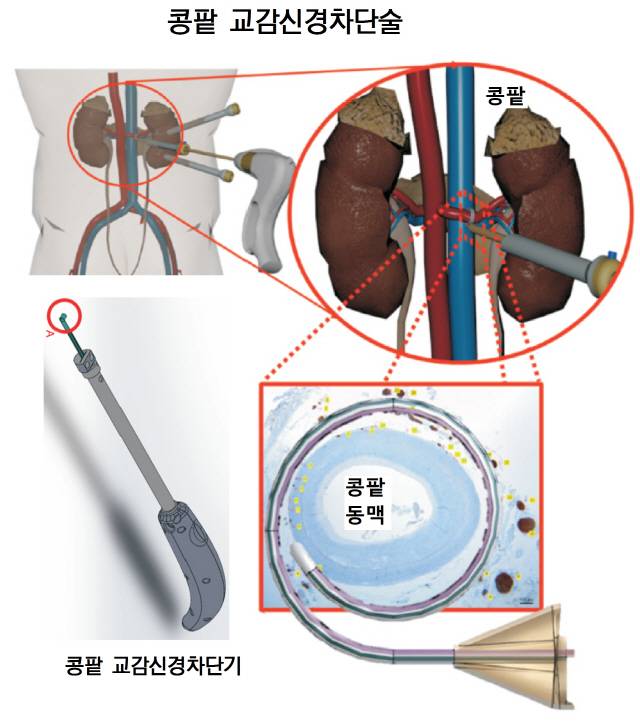 약 안듣는 저항성 고혈압 교감신경 차단술로 치료