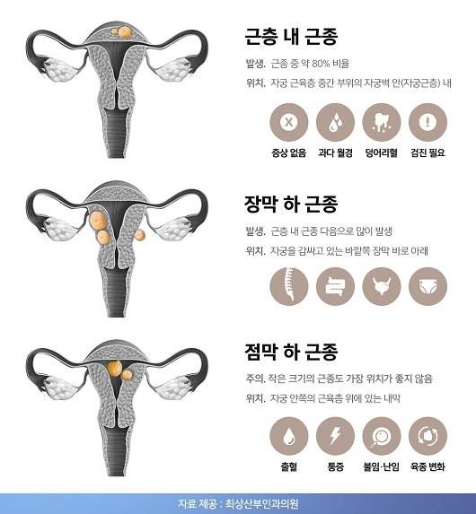자궁근종 치료 크기∙위치 고려해서 결정해야
