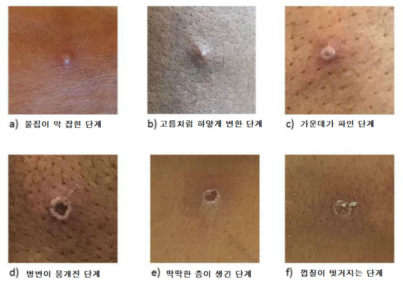 원숭이 두창 사진 보기 싫어 그래도 참고해야 할 병변 사진