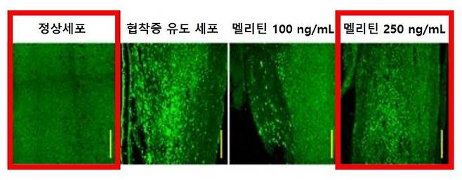 봉독 성분 멜리틴 척추관협착증 치료 효과 규명