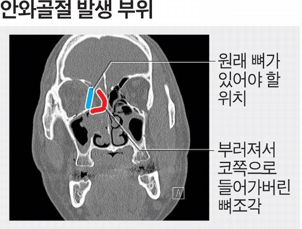 손흥민 겪은 안와골절 일상서 빈번시력변화 땐 2주내 수술해야