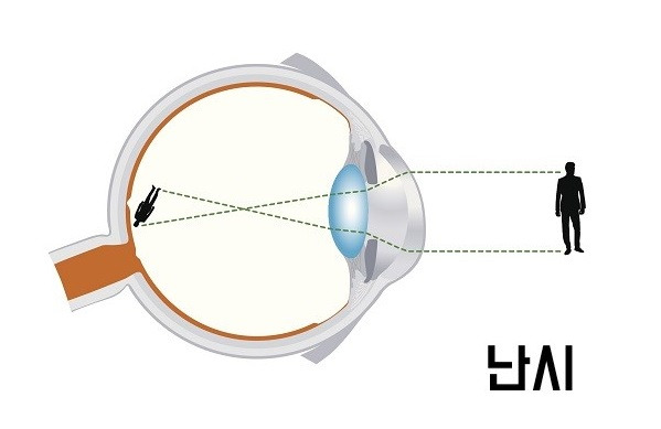 근시와 난시 둘 다 있을 땐안경 렌즈 라식 눈사람
