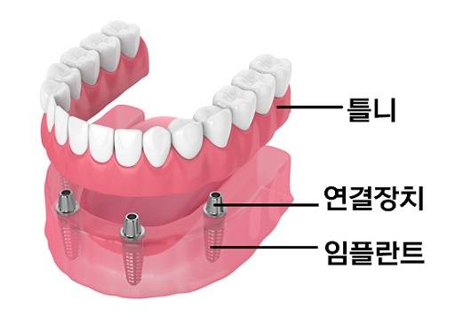 건강톡톡 틀니 빼기 귀찮은데잘 때도 계속 끼면