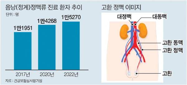 남성 난임 부르는 ‘정계정맥류고환 묵직하거나 아프면 의심을