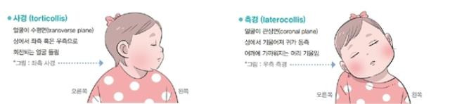 기울어진 아기 목사경 측경 오인해 집에서 잘못된 재활 운동 많아