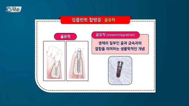 약손 뿌리부터 튼튼 제3의 치아 임플란트 ⑮생물학적 합병증