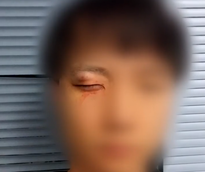 워킹홀리데이 가서 집단폭행 당했다호주서 인종차별 당한 20대 한국인