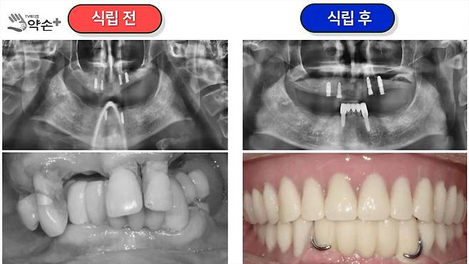 약손 다수의 치아상실 재건 전악보철 ⑰가철성 보철