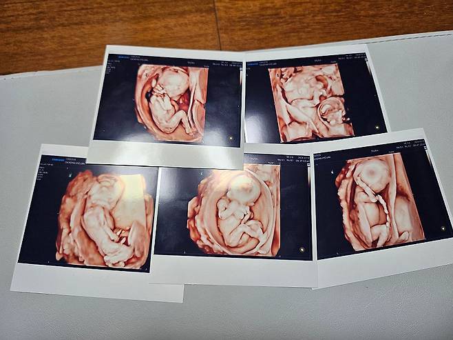 오둥이 넷째 다섯째 수술 이젠 걱정보다 행복多태아보험 아쉬워