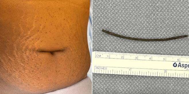 이 기계 쓰다가 7cm 금속 뱃속 깊이 박혀 잔디 깎을 때 조심해야