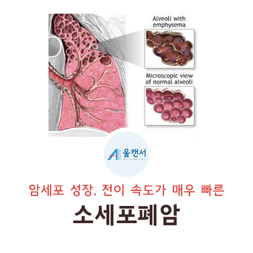 현재 난리났다는 소세포폐암 암억제 연구 근황 ㅎㄷㄷㄷㄷ 에펨코리아