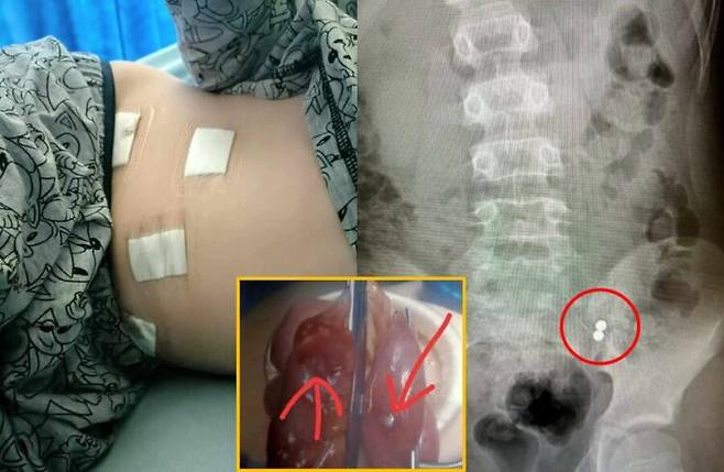 자석볼 던져 놀다가 뱃속으로 쏙~장에 구멍 뚫릴 뻔한 12세 무슨 일