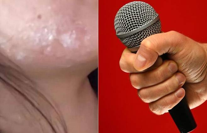 물집이 코 뺨에도”노래방서 이것‘ 감염돼 8년째 고통받는 女 무슨 일